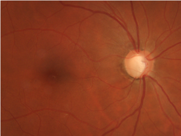 Glaucoma in Saint Paul and Eden Prairie, MN | Wallerich Eye Care